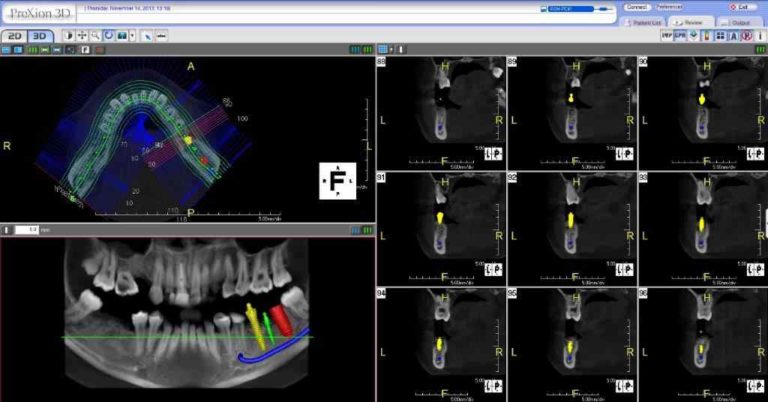 PreXion 3D Pro Excelsior CBCT Scanner - All Practice Solutions