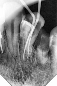 Woodpecker DBA I Sensor - Digital X-Ray with Free Software